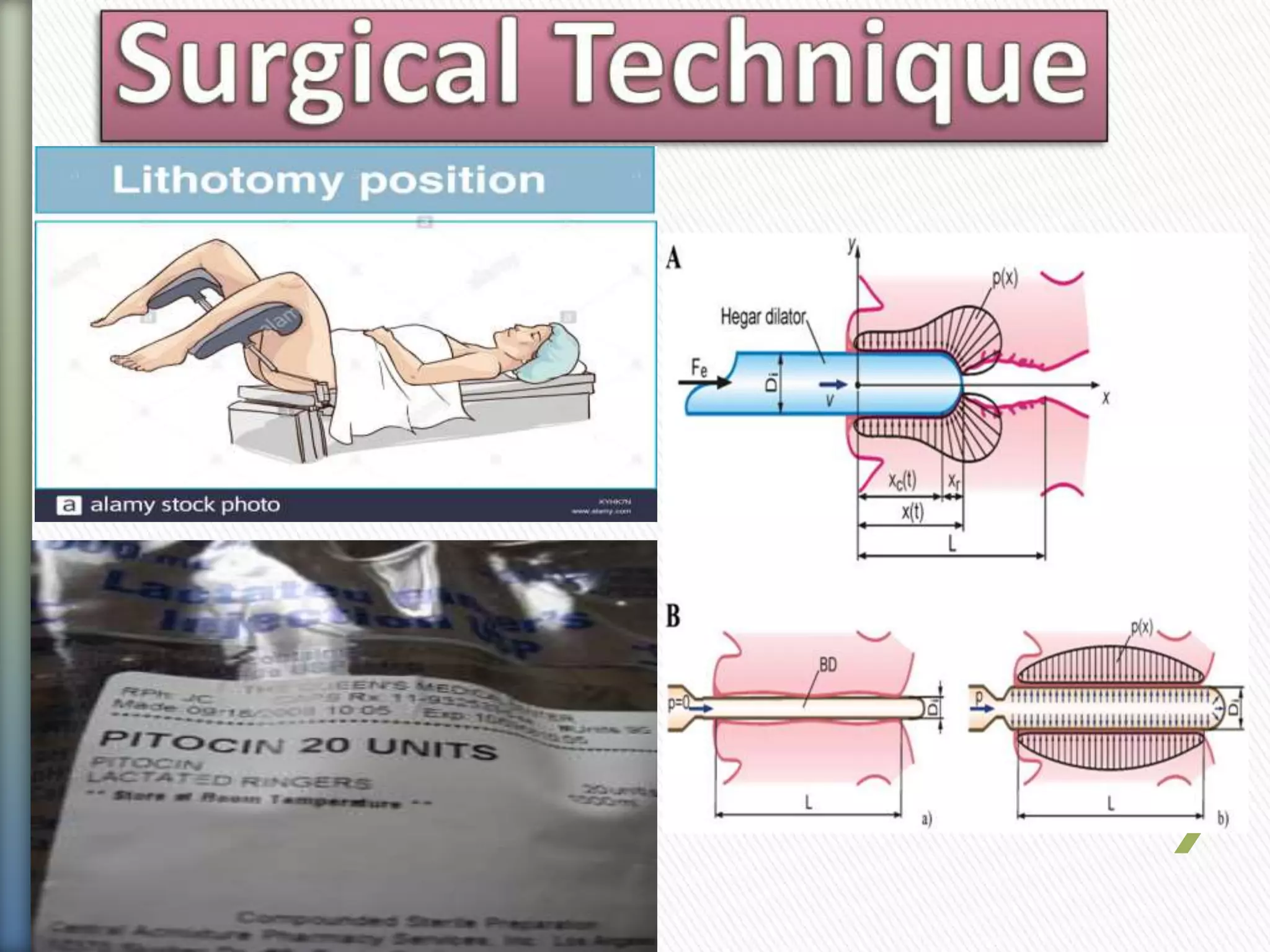 Introduction,dilataion and curretage&suction curetage | PPTX