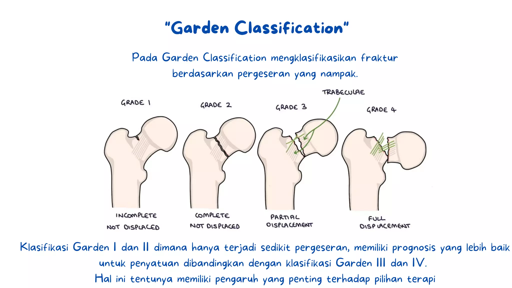 Introduction Hip Fracture_Putri Karina.pdf