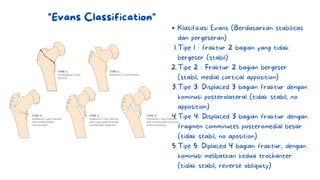 Introduction Hip Fracture_Putri Karina.pdf