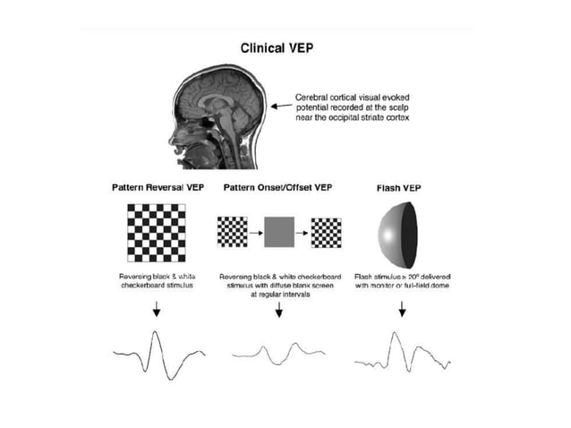 Introduction, history and neurophysiologic basis of vep | PPT