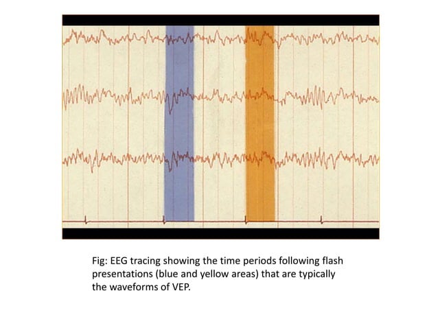 Introduction, history and neurophysiologic basis of vep | PPT