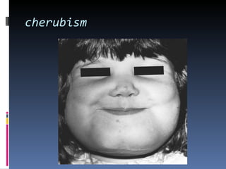 Introduction of fibroosseous lesions | PPT