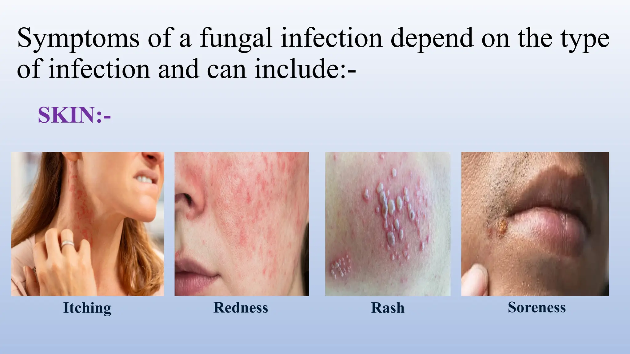 Fungus, Classification, Disease, Symptoms, Prevention, Treatment,etc.pptx