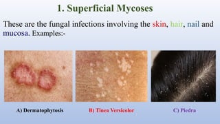 Fungus, Classification, Disease, Symptoms, Prevention, Treatment,etc.pptx