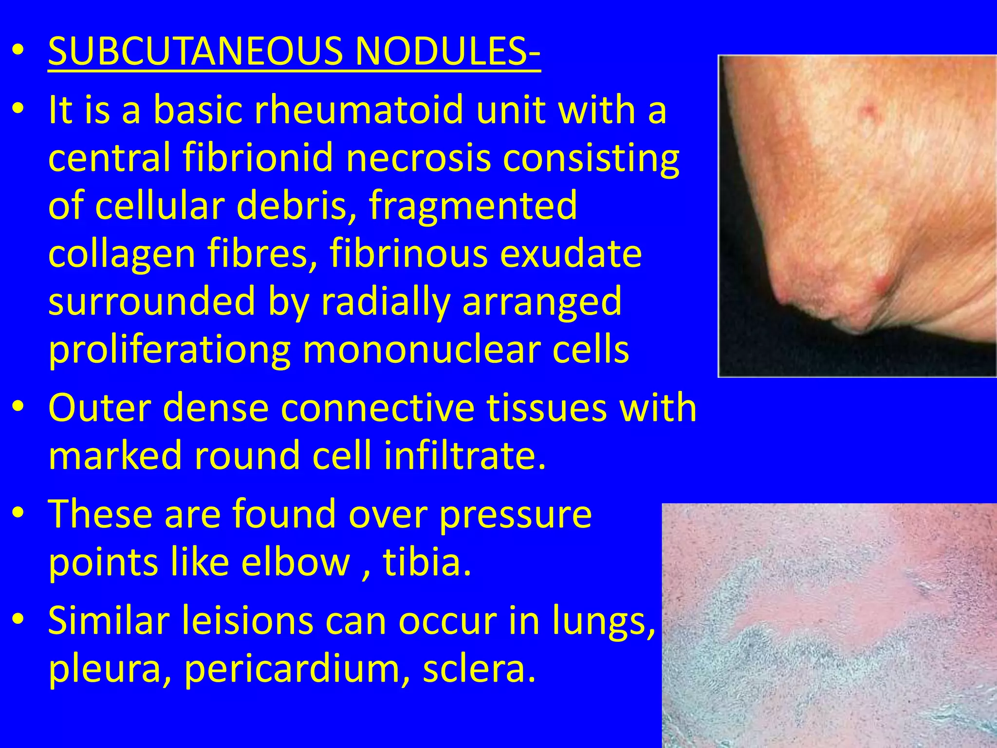 Introduction ,pathogenesis , clinical manifestations of rheumatoid | PPTX