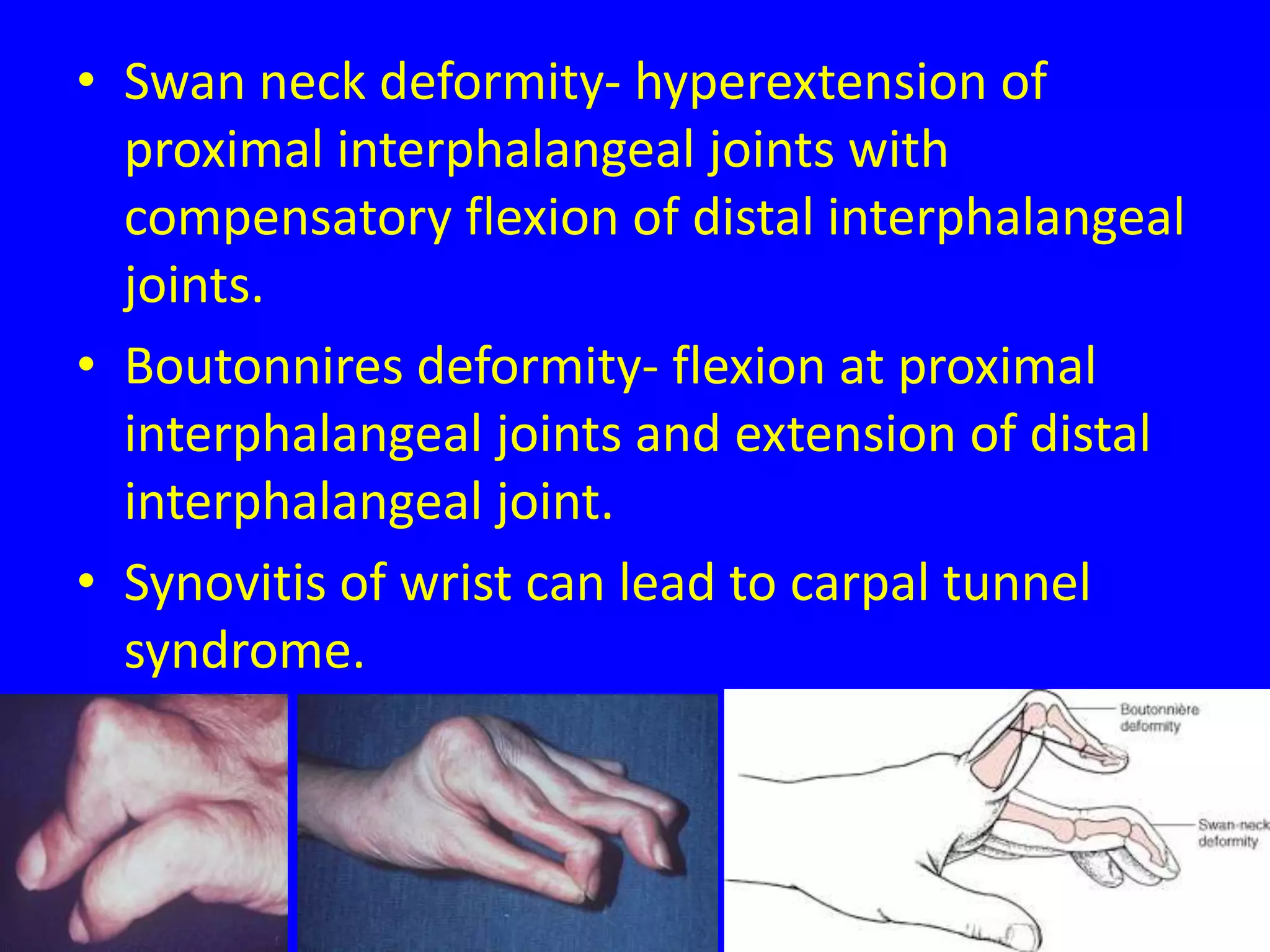 Introduction ,pathogenesis , clinical manifestations of rheumatoid | PPTX