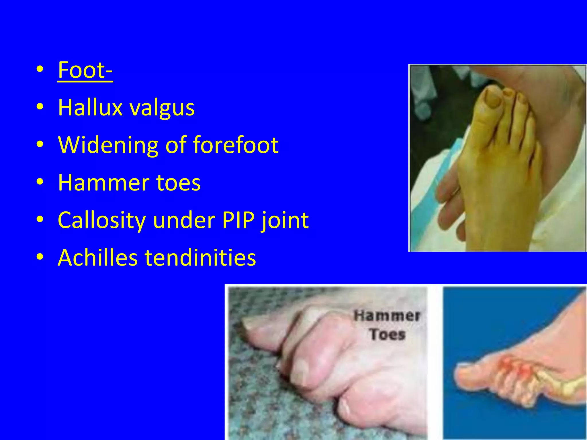 Introduction ,pathogenesis , clinical manifestations of rheumatoid | PPTX