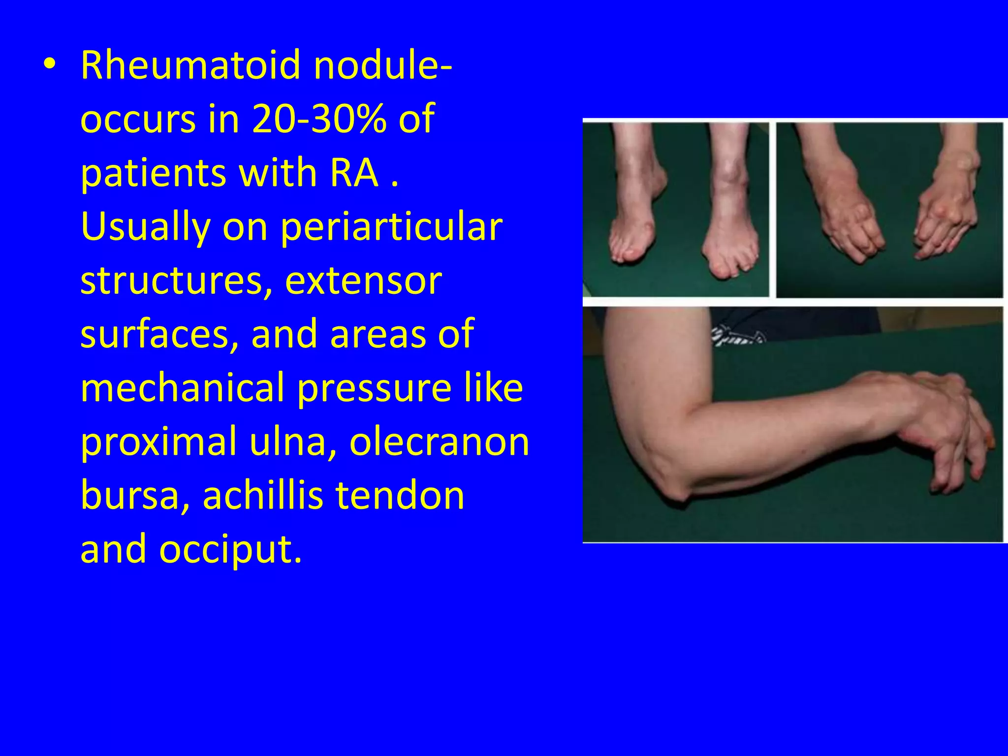 Introduction ,pathogenesis , clinical manifestations of rheumatoid | PPTX