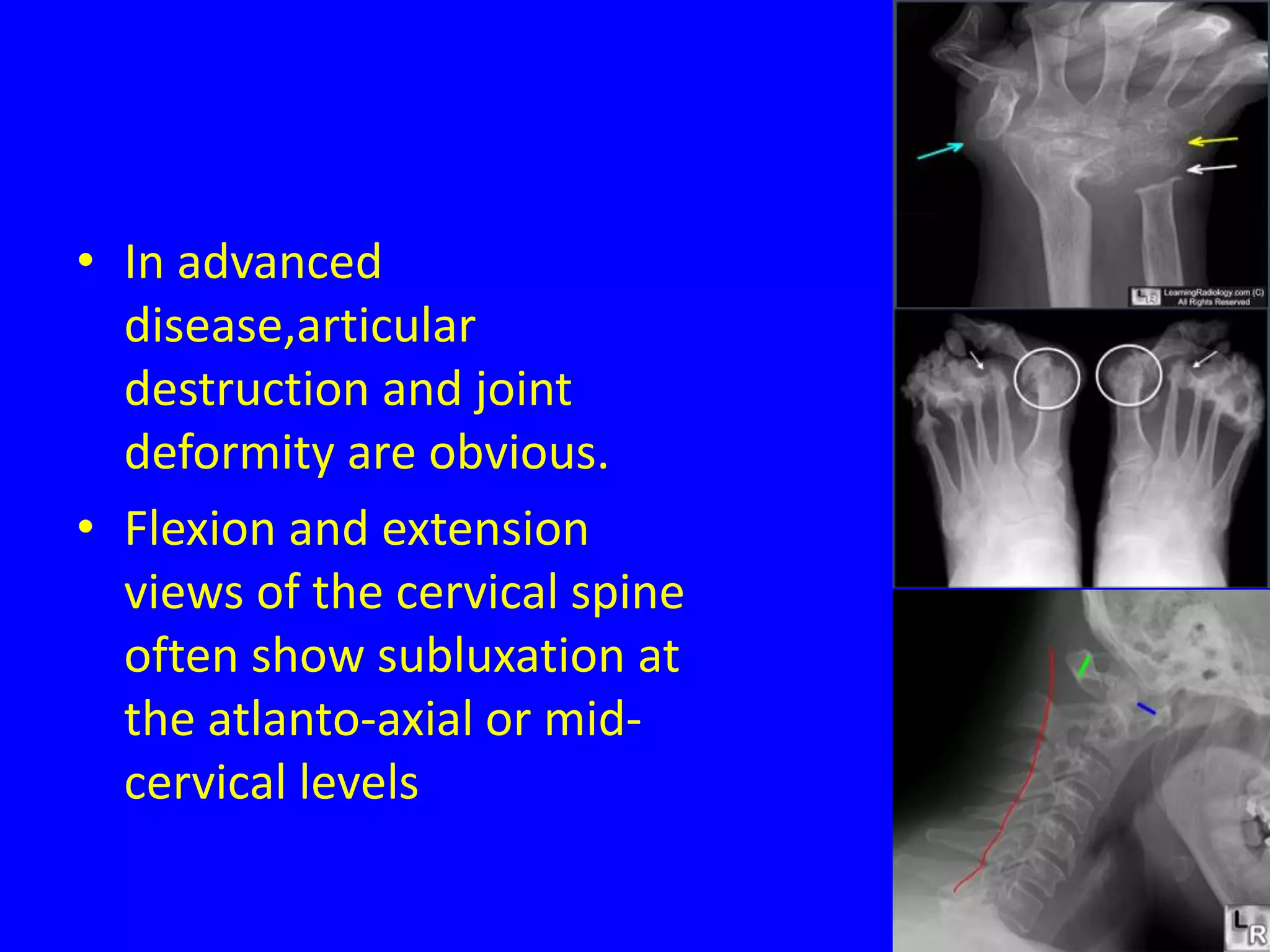Introduction ,pathogenesis , clinical manifestations of rheumatoid | PPTX