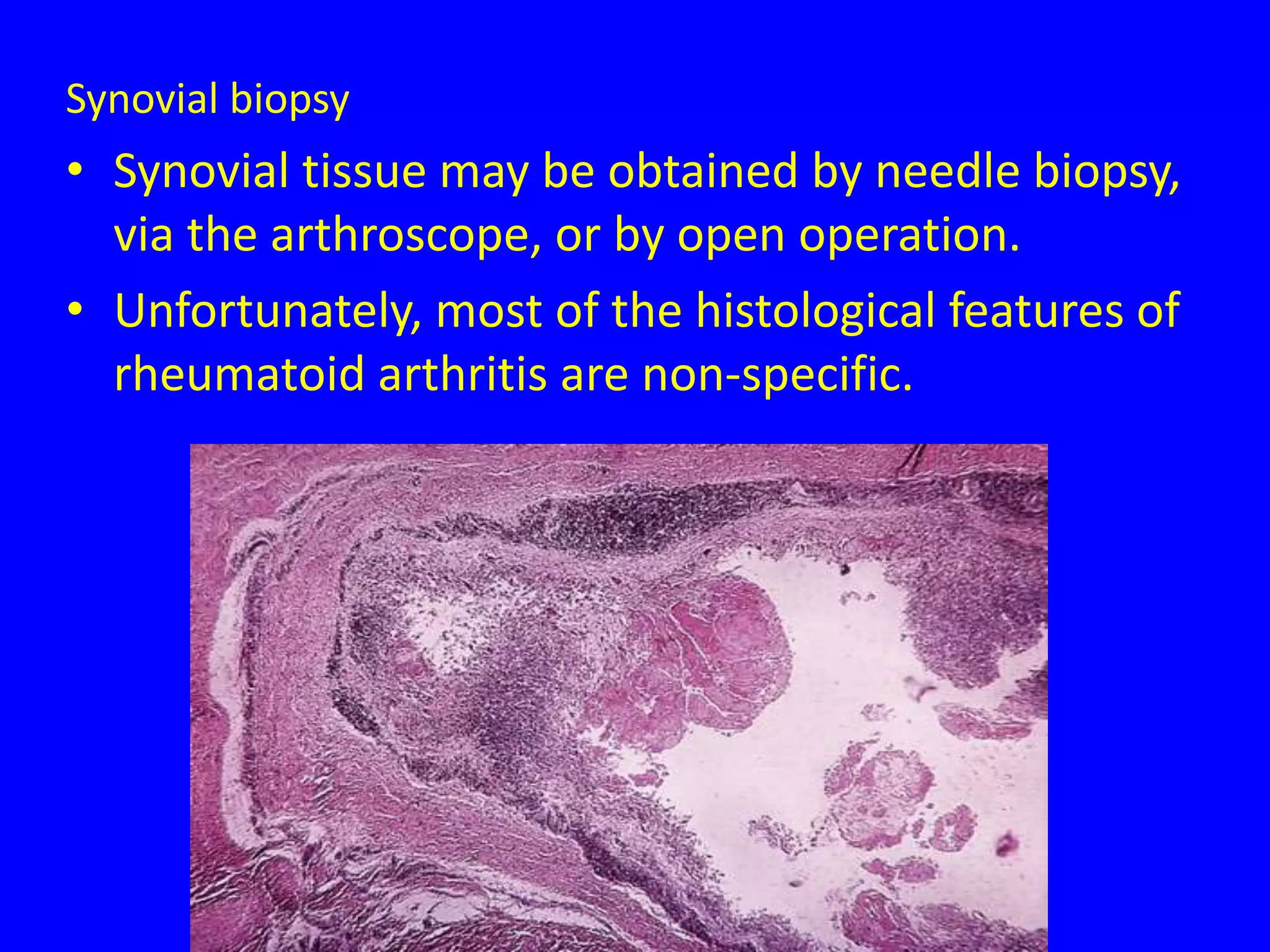 Introduction ,pathogenesis , clinical manifestations of rheumatoid | PPTX