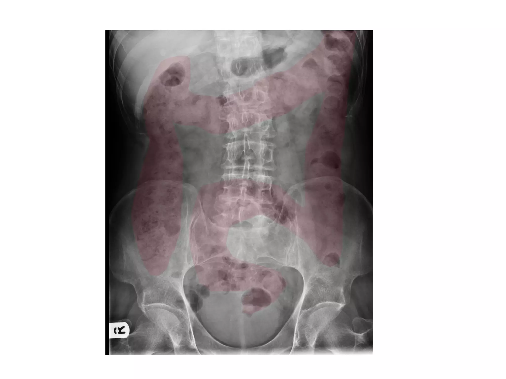 Introduction to abdominal x ray interpretation | PPT