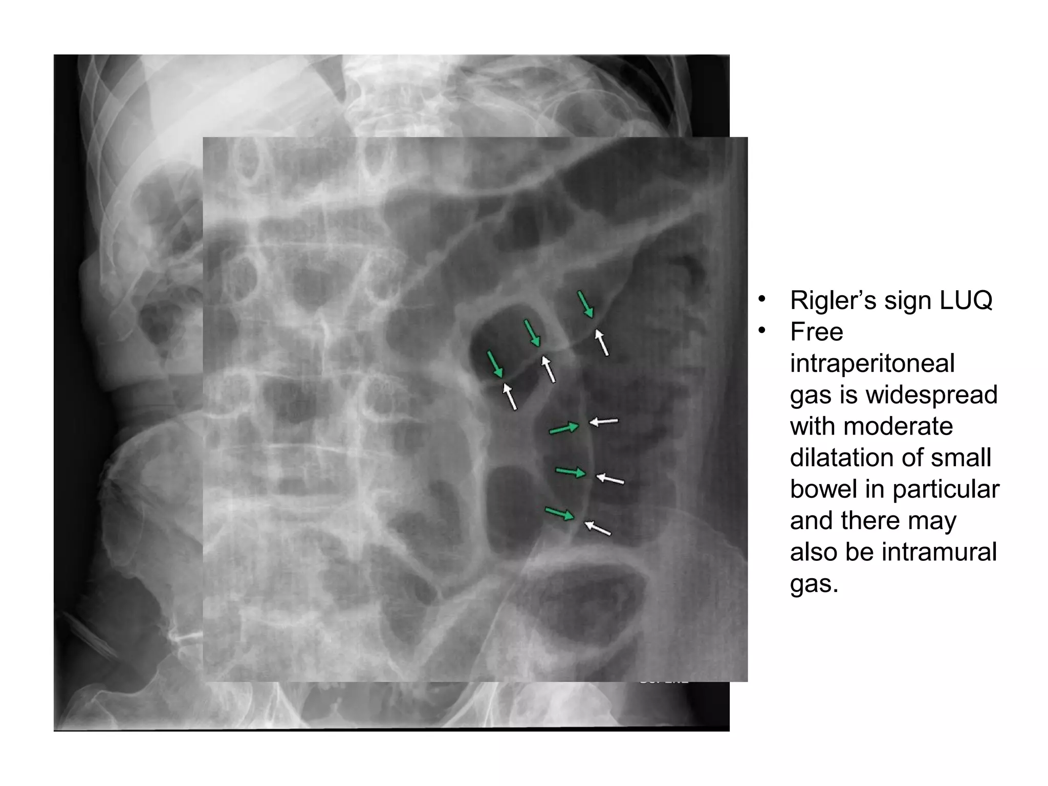 Introduction to abdominal x ray interpretation | PPT