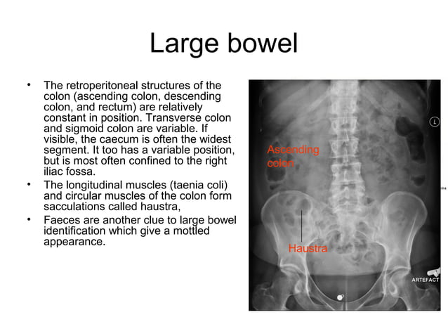 Introduction to abdominal x ray interpretation | PPT