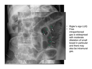 Introduction to abdominal x ray interpretation | PPT