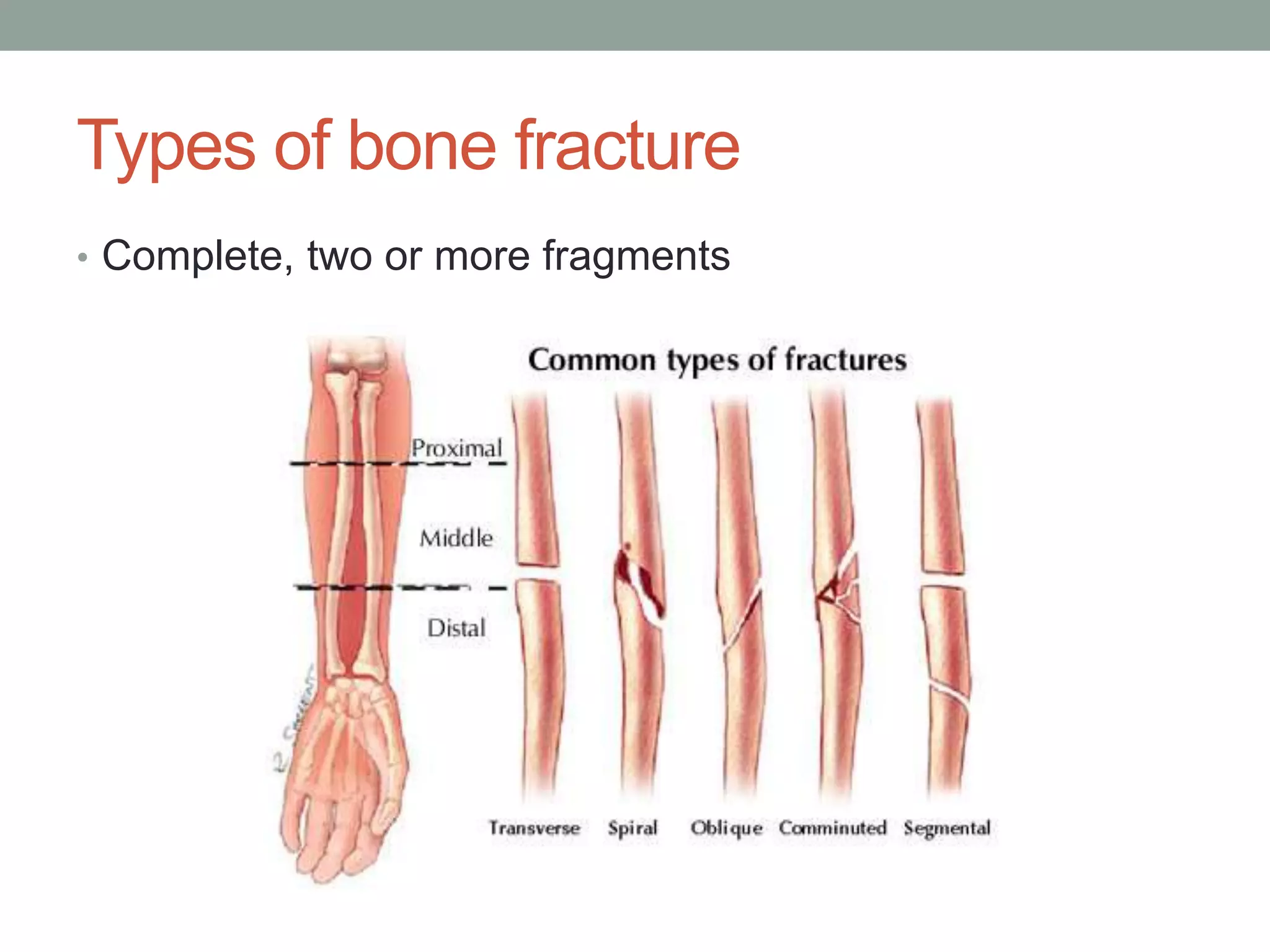 Introduction to bone fracture | PPTX