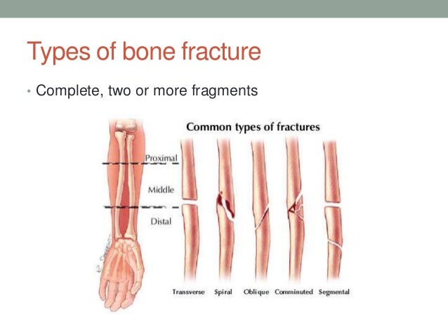 Introduction to bone fracture