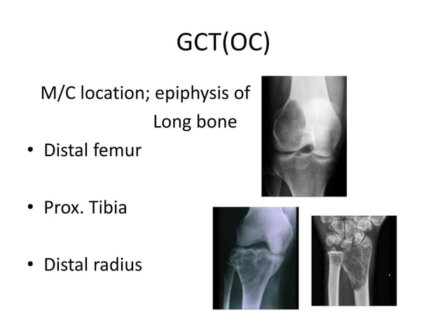 Introduction to bone tumours and GCT | PPT