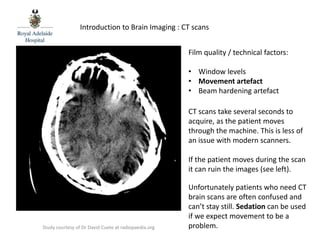 RAH Med 4 MHU - Brain CT 1 | PPTX