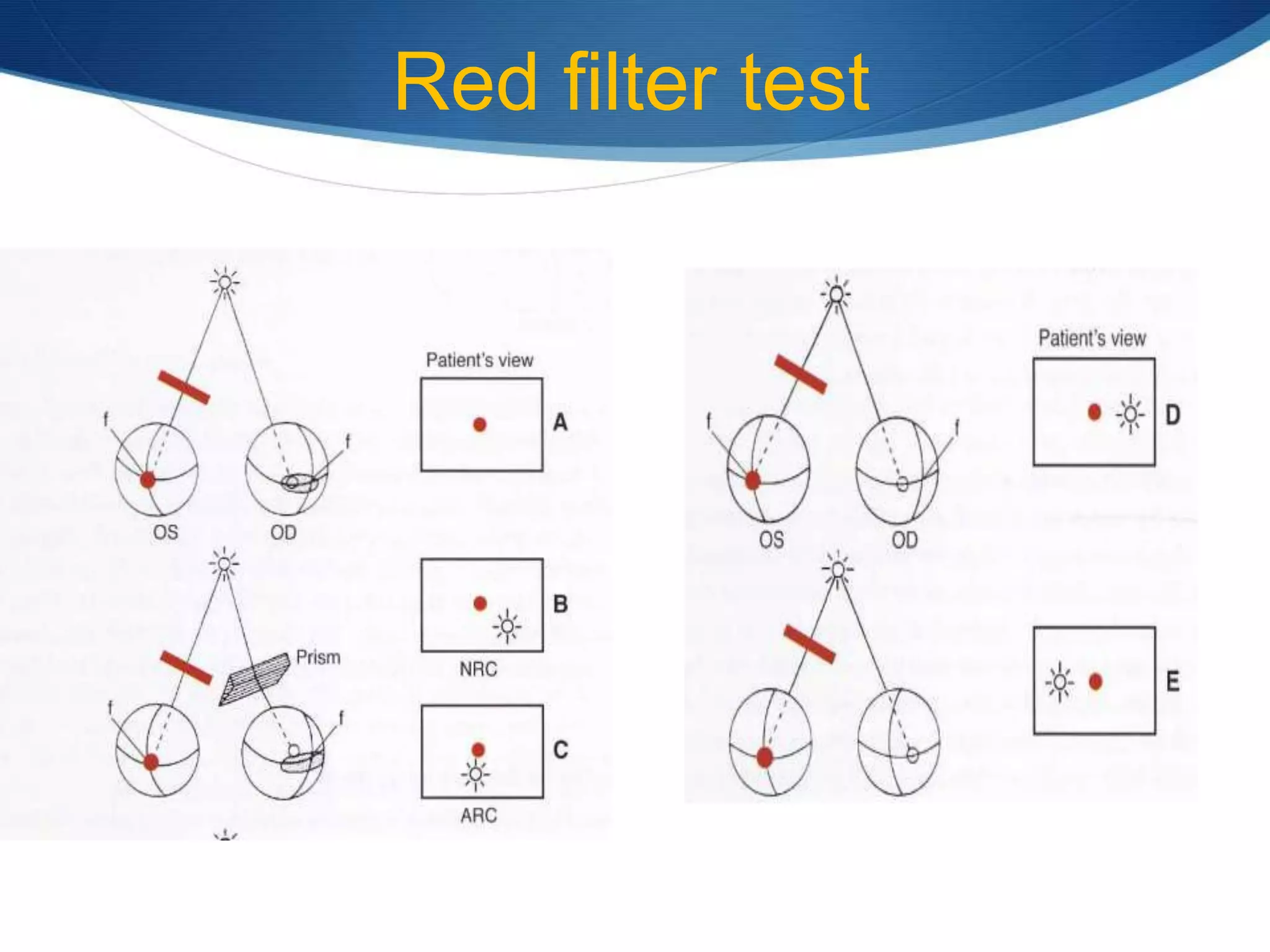 Introduction to binocular single vision (BSV) | PPTX