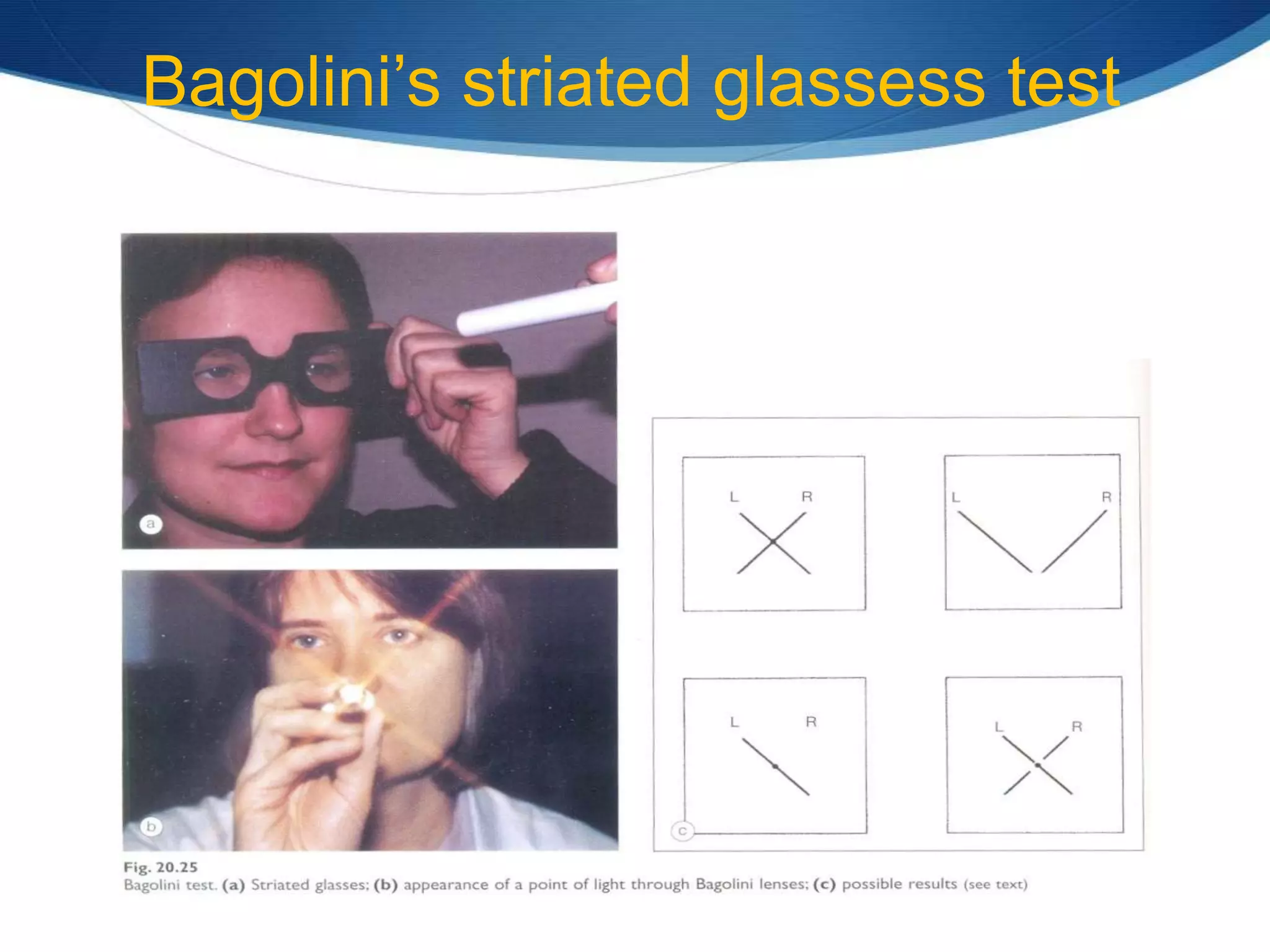 Introduction to binocular single vision (BSV) | PPTX
