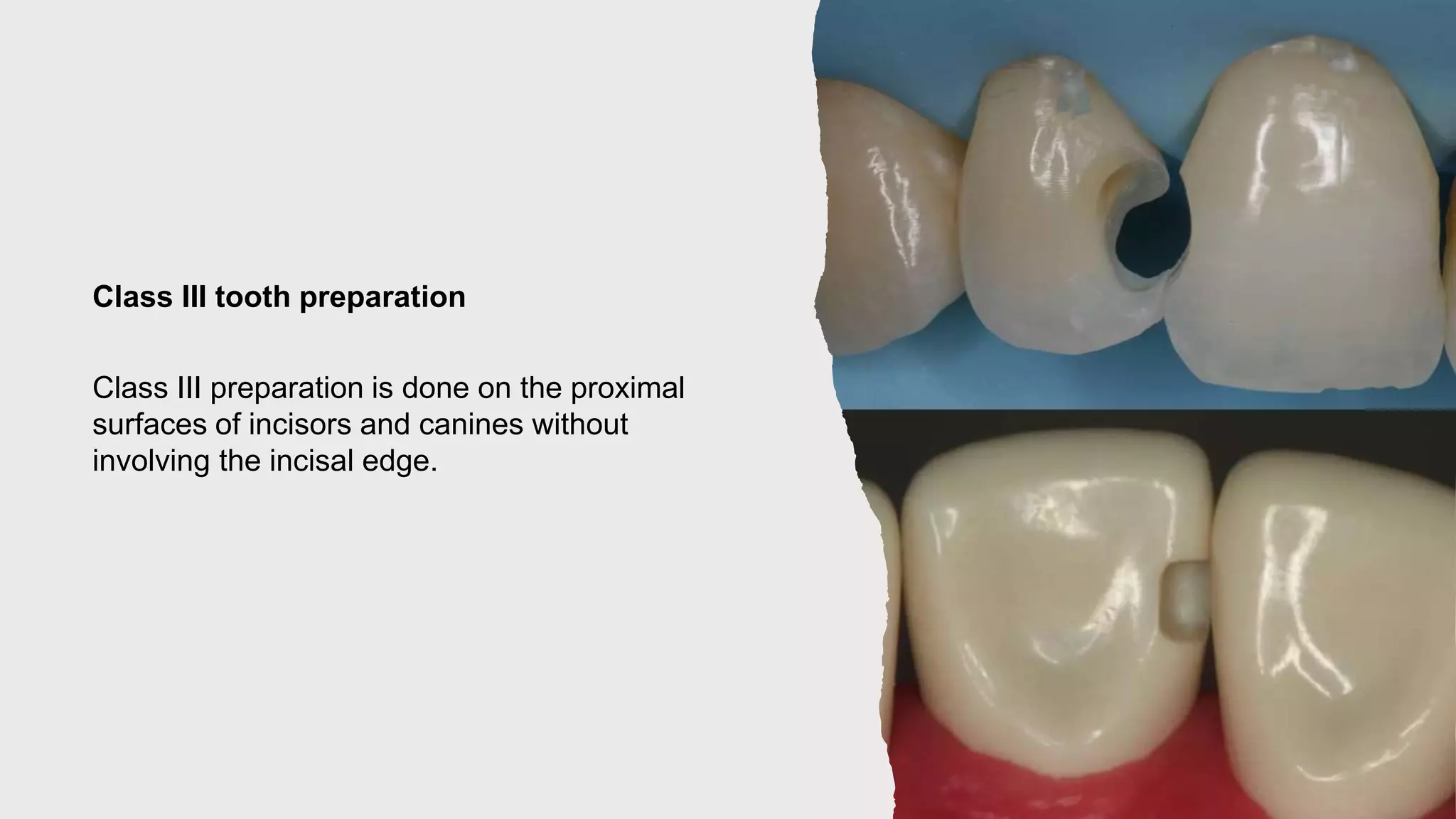 Introduction to cavity preparation and materials.pptx
