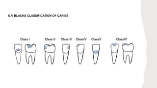 Introduction to cavity preparation and materials.pptx