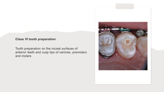 Introduction to cavity preparation and materials.pptx