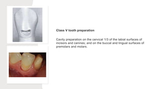 Introduction to cavity preparation and materials.pptx