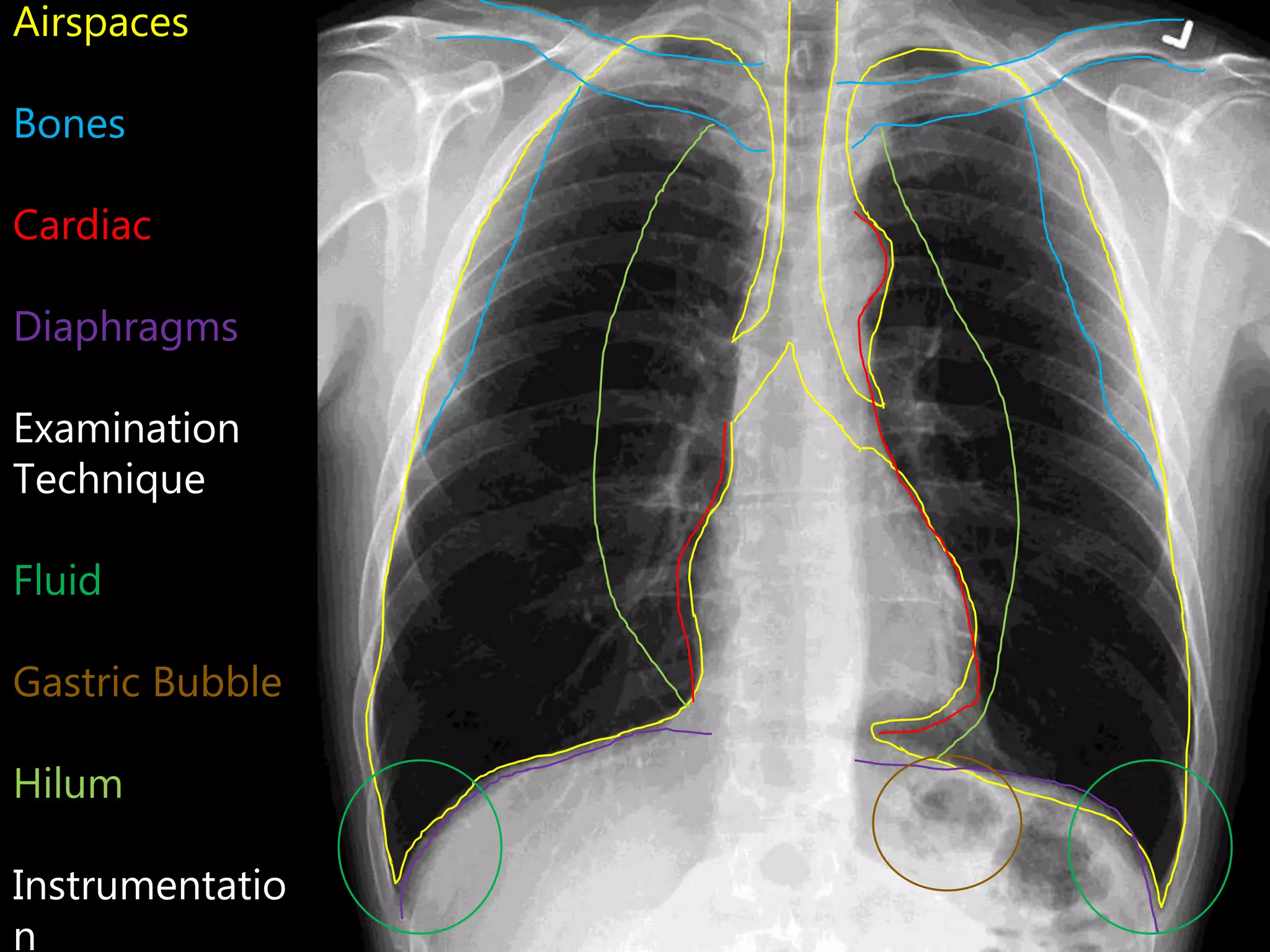 Introduction to Chest X-Ray Interpretation | PPTX