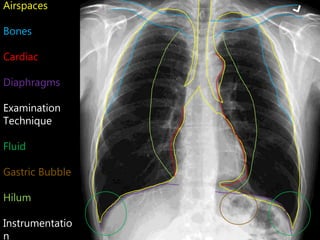 Introduction to Chest X-Ray Interpretation | PPTX