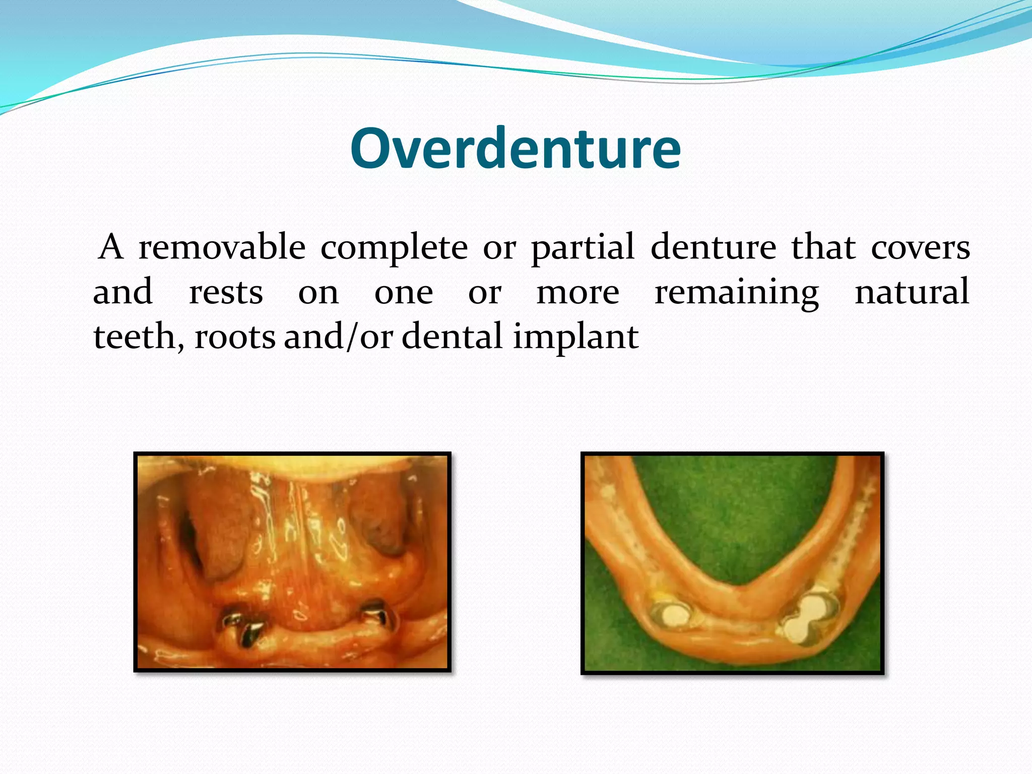 Introduction to complete_denture | PPTX