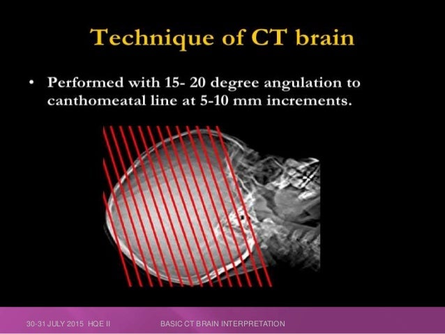Introduction to CT Brain: The Basic Principles Introduction to CT Brain: The Basic Principles