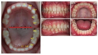 Introduction to Dental Anatomy and Tooth numbering system | PPTX