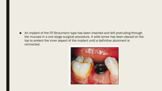 Introduction to dental implants from bdj | PPTX