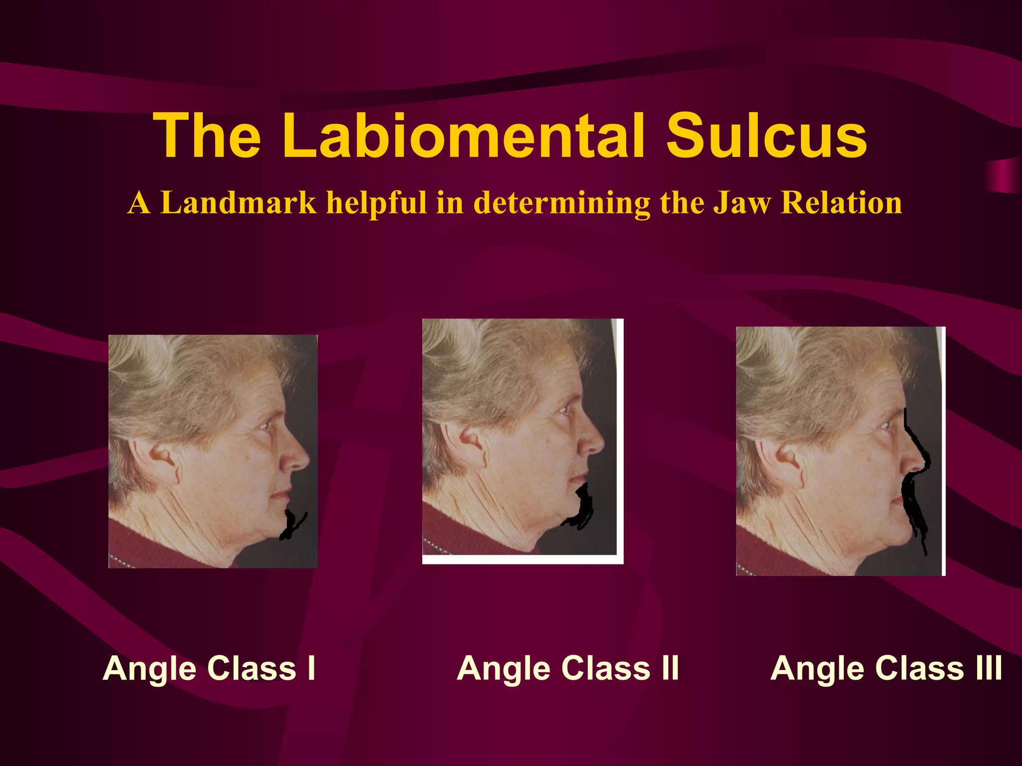 Introduction to prosthodontics | PPT
