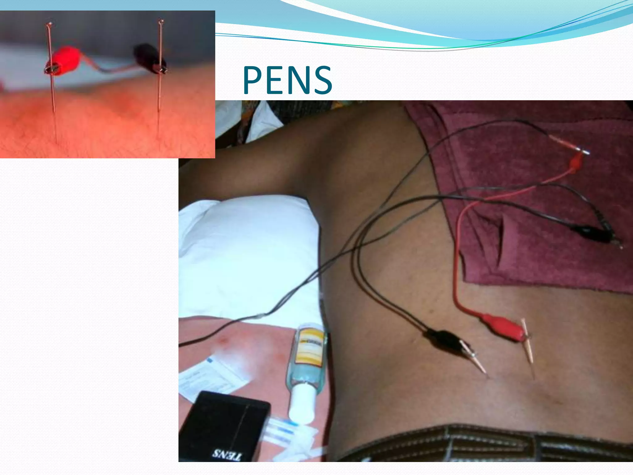 Introduction to dry needling | PPTX