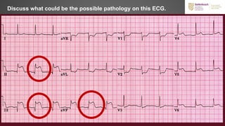 INTRODUCTION TO ECG (ELECTROCARDIOGRAM) EKG | PPTX