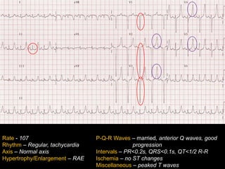 Introduction to EKG Interpretation | PPTX