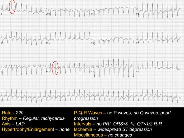 Introduction to EKG Interpretation | PPT