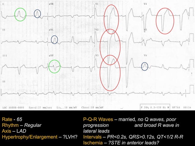 Introduction to EKG Interpretation | PPT