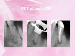 Introduction to endodontics2009(new) | PPT