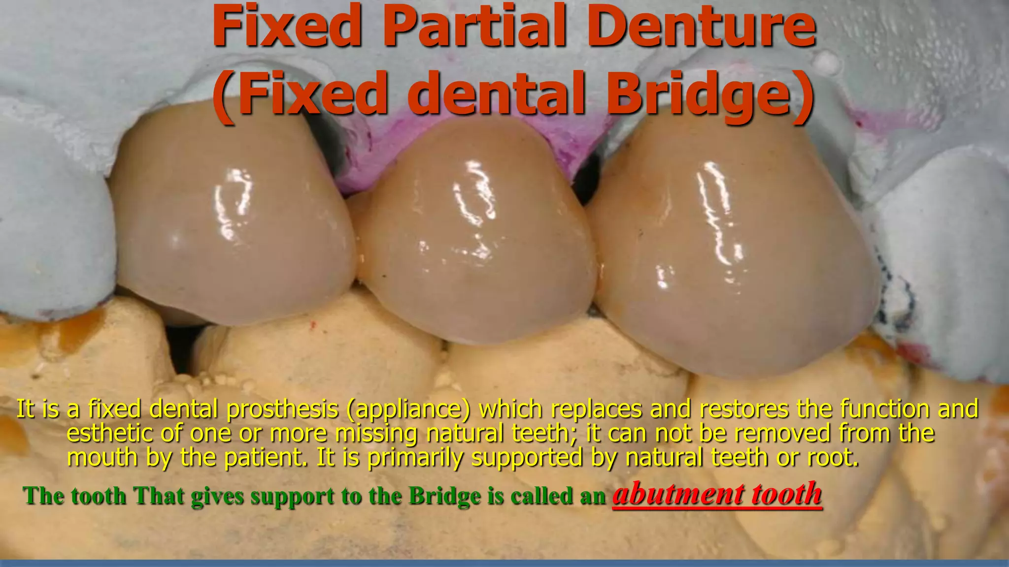 Introduction to fixed prosthodontics | PPTX