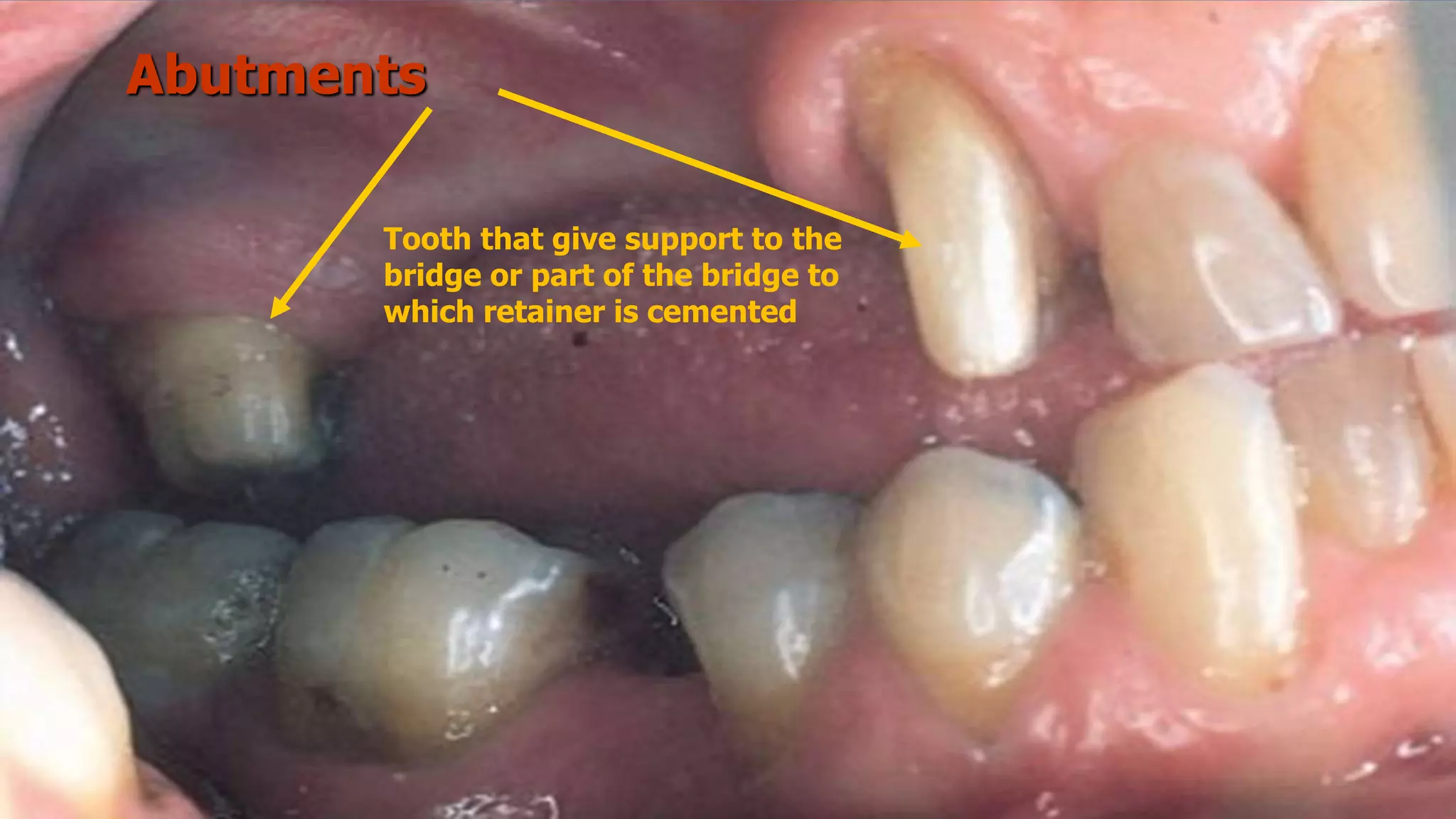 Introduction to fixed prosthodontics | PPTX