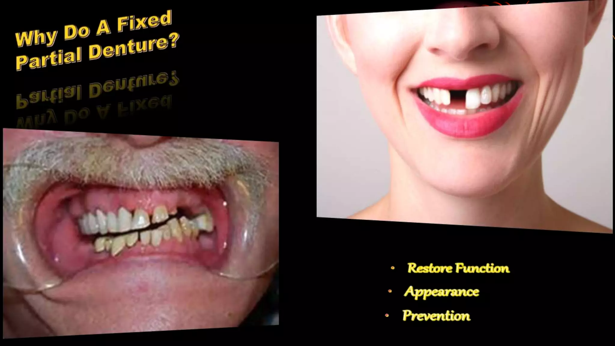 Introduction to fixed prosthodontics | PPTX