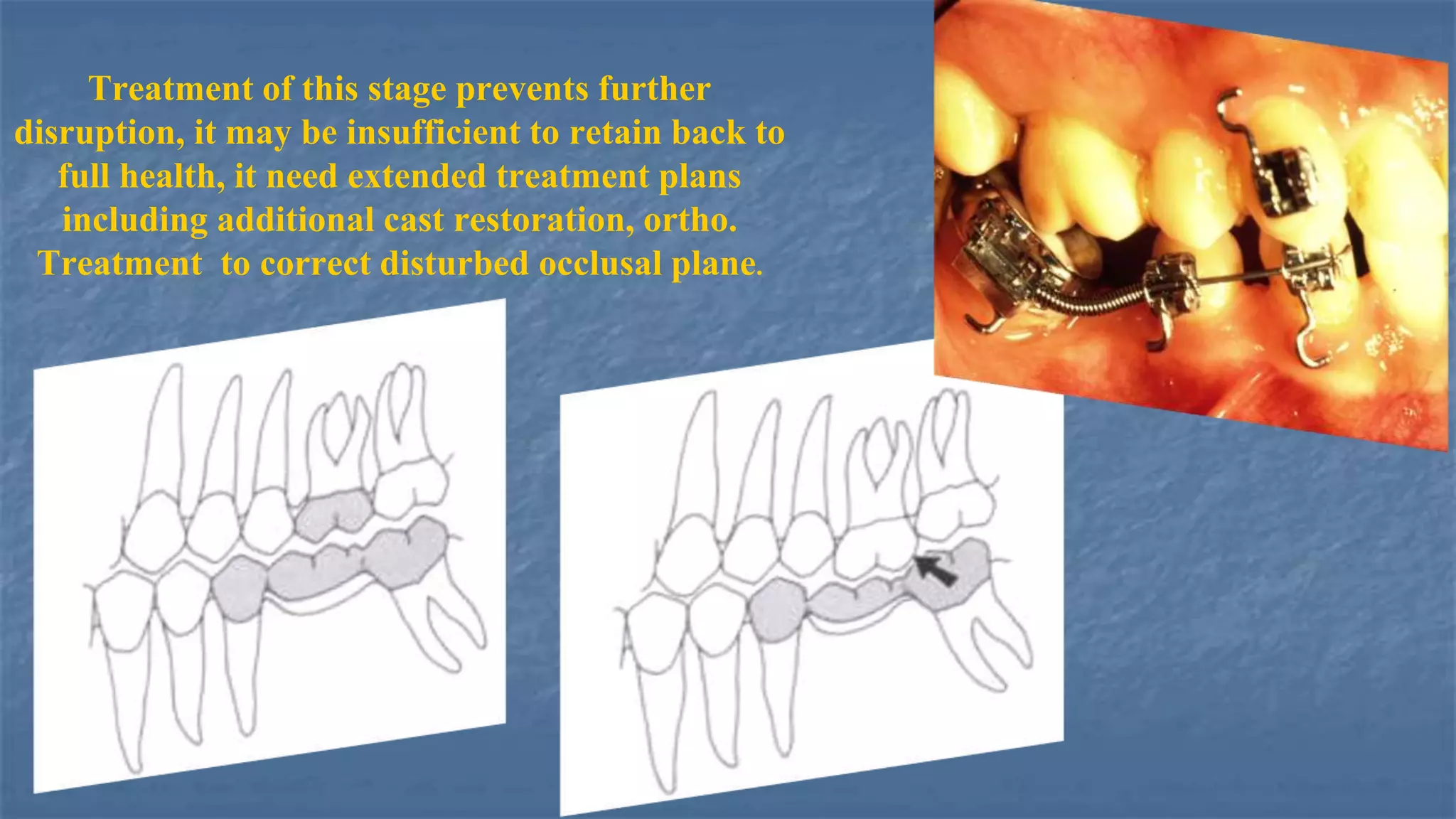 Introduction to fixed prosthodontics | PPTX