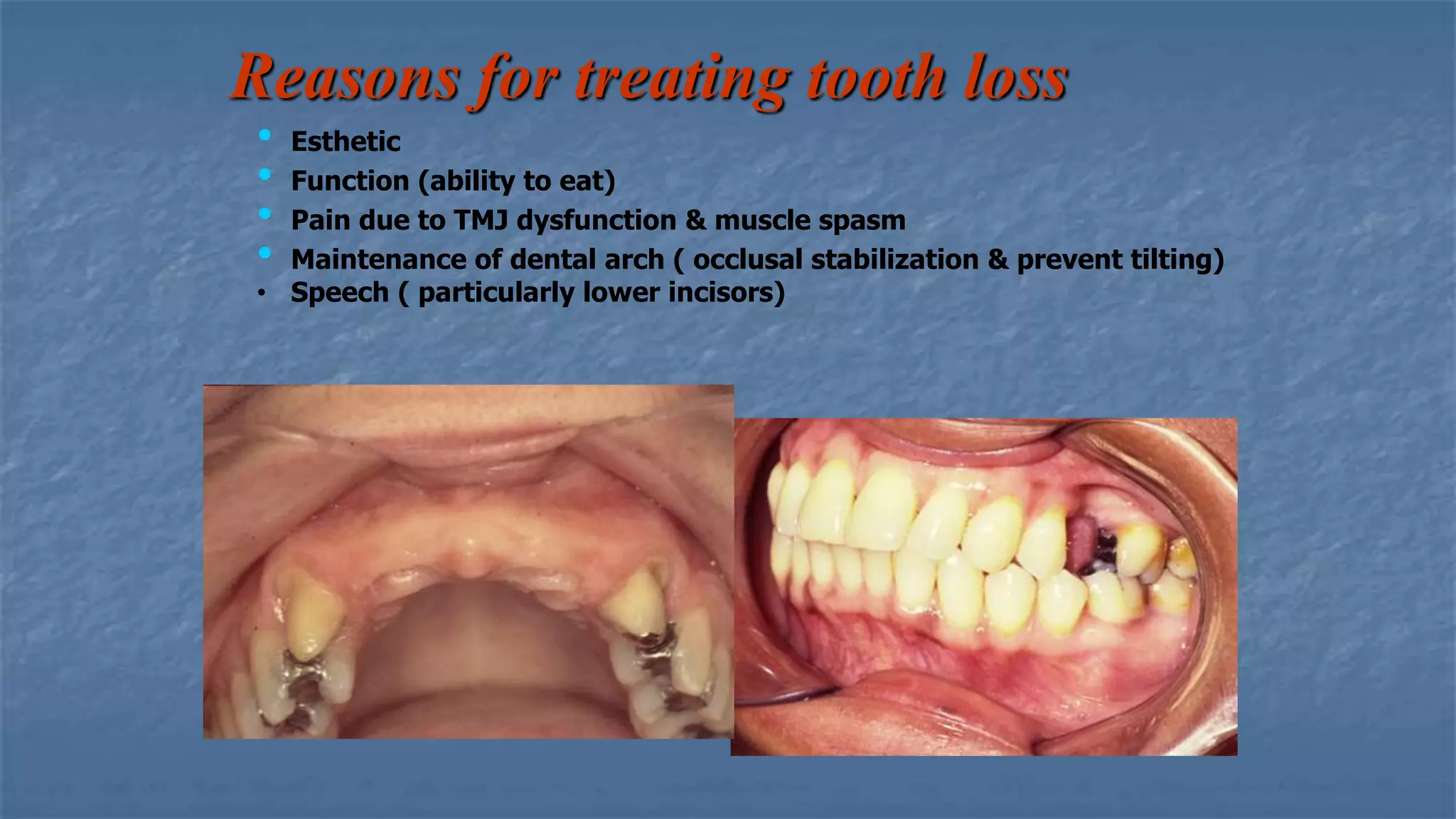 Introduction to fixed prosthodontics | PPTX