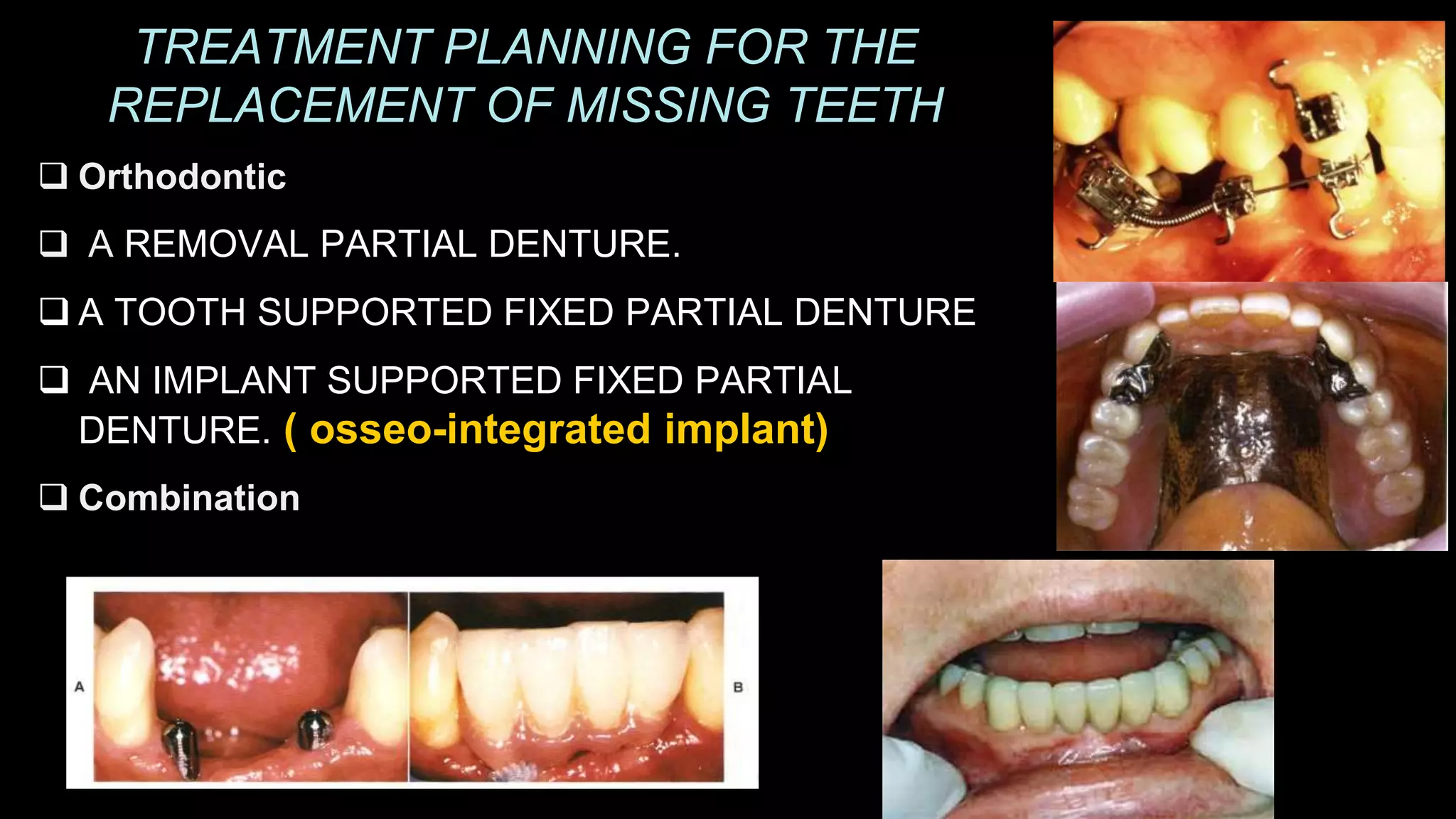 Introduction to fixed prosthodontics | PPTX