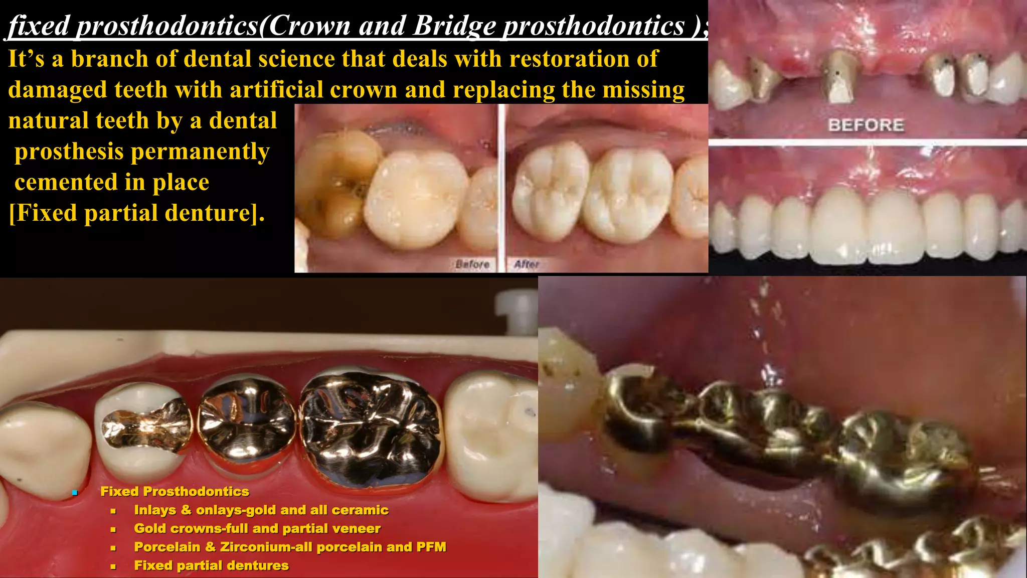 Introduction to fixed prosthodontics | PPTX