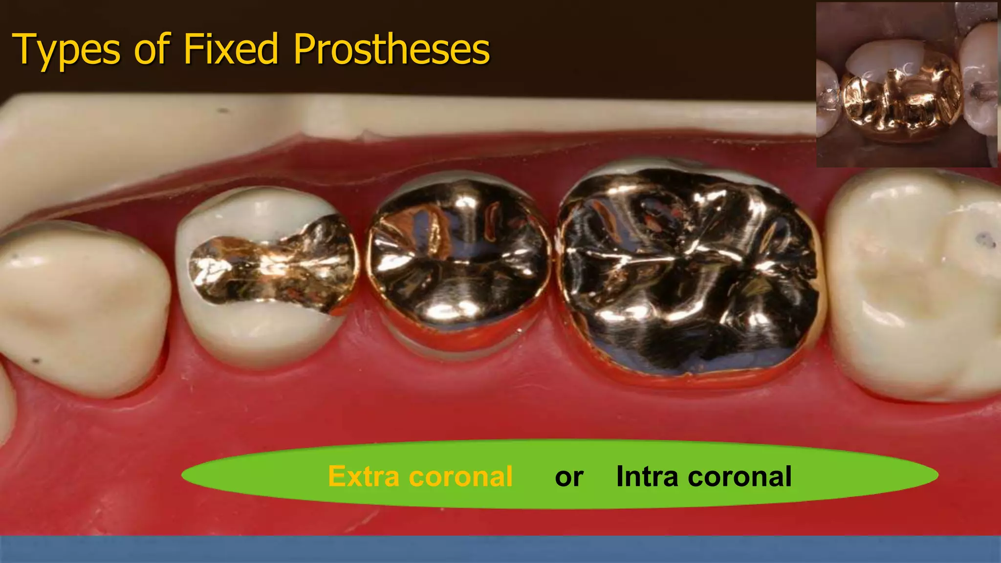 Introduction to fixed prosthodontics | PPTX