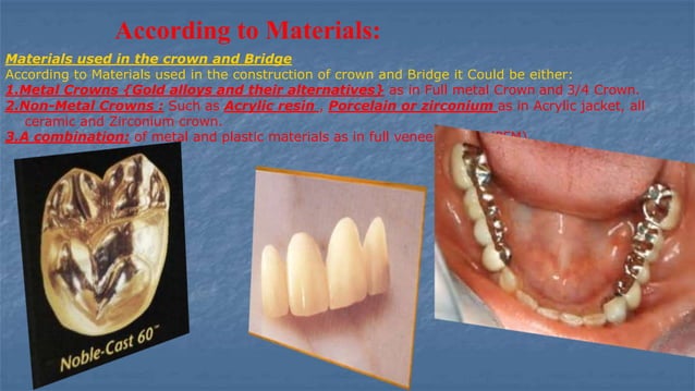 Introduction to fixed prosthodontics | PPT